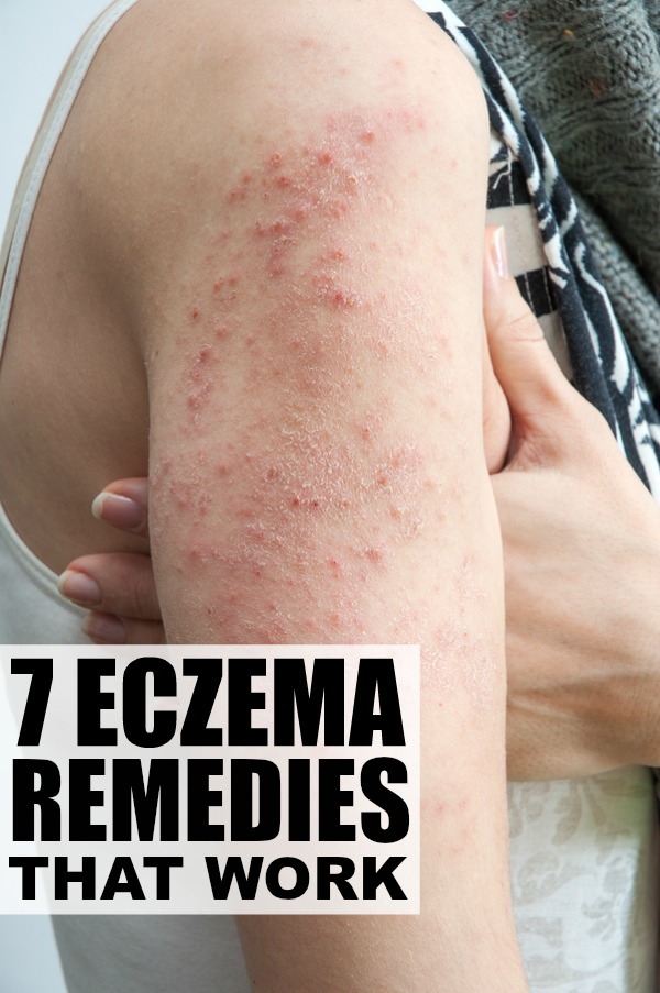 What Causes Eczema Flare Ups Indianlockq What Causes Eczema Flare Ups Indianlockq