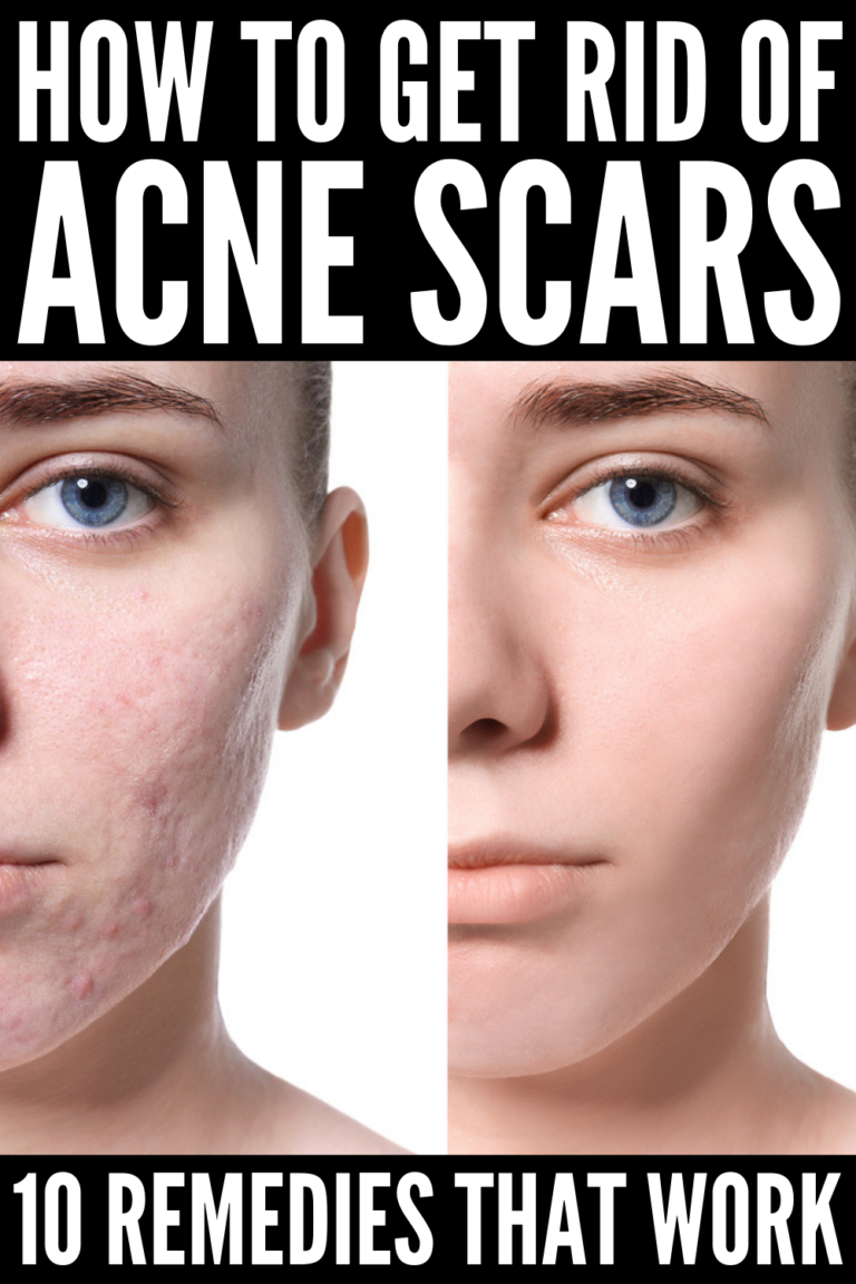 How to Get Rid of Acne Scars: 10 Products and Remedies to Try