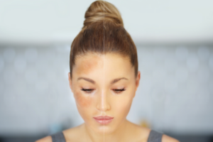 7 Simple and Safe Natural Melasma Remedies