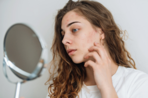 Skin Purging or Breaking Out? 31 Things to Know